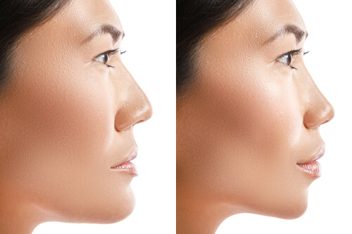 Korean Nose Job Before and After