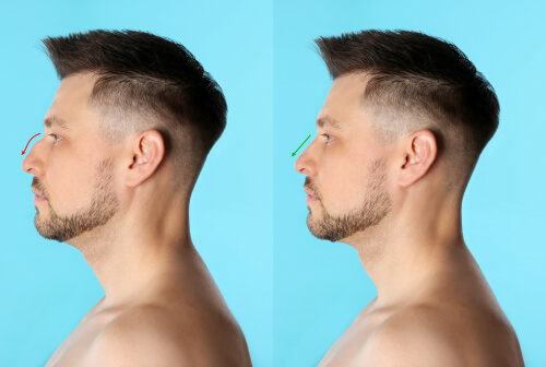 Nose Job for Men: How to Get the Best Results- Rhinoplasty Sydney Cost