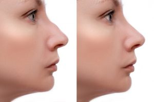 Cartilage Bump on Tip of Nose: Understanding This Common Aesthetic ...